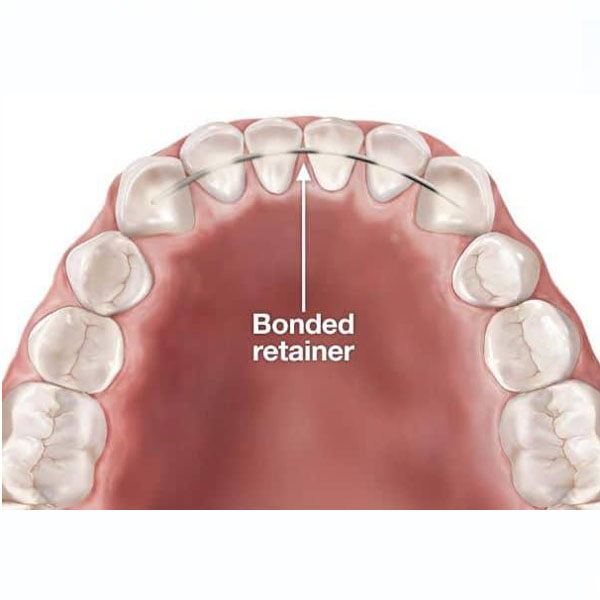 Retainer - Fixed Bonded Wire - Forever Aligned Club